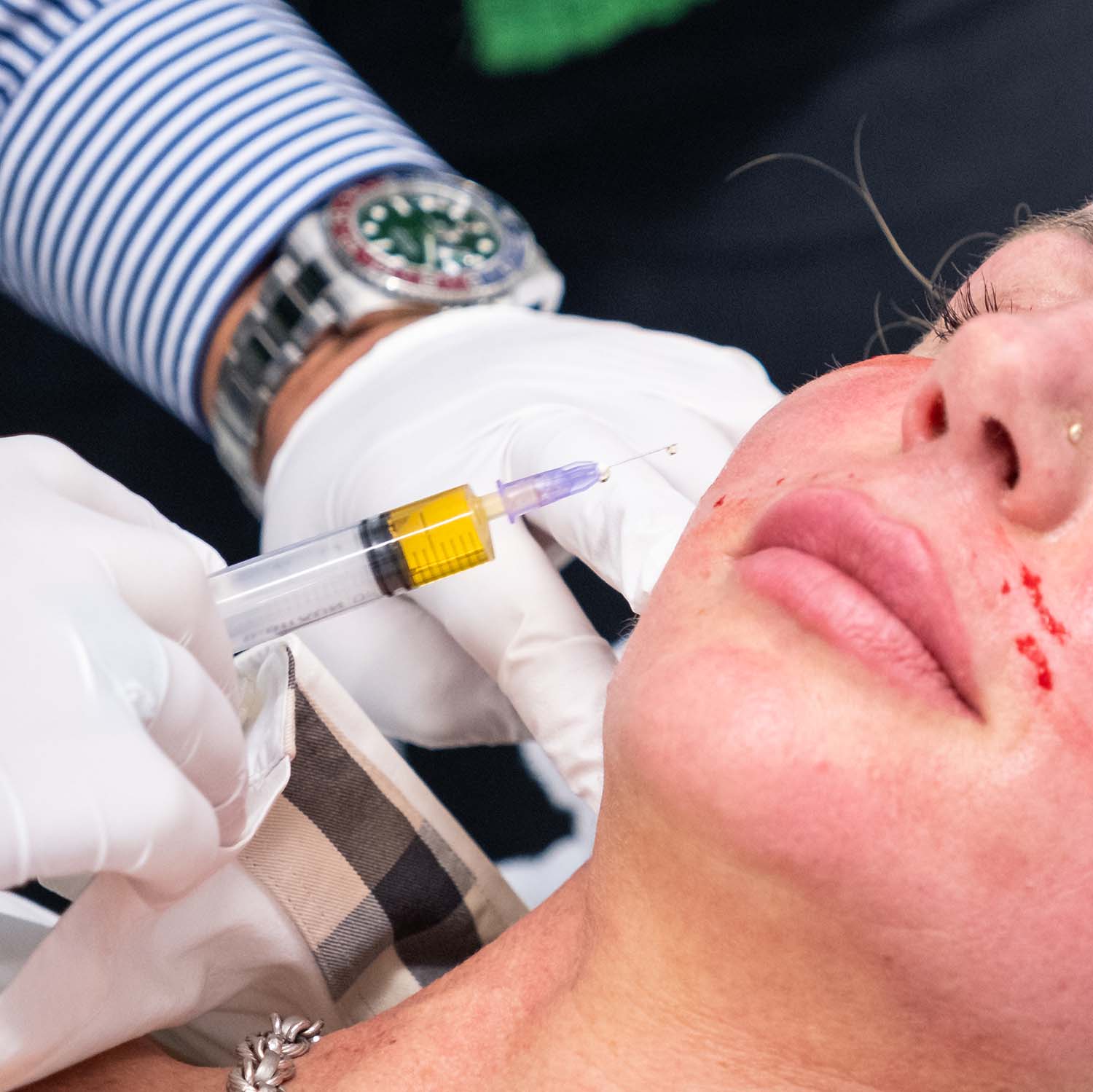 PRP Set Vampirlift | 100199